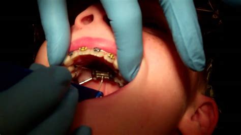 How To Turn A Expander YouTube