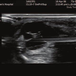 A Doxycycline Injection Monitored With Real Time Sonography B Download Scientific Diagram