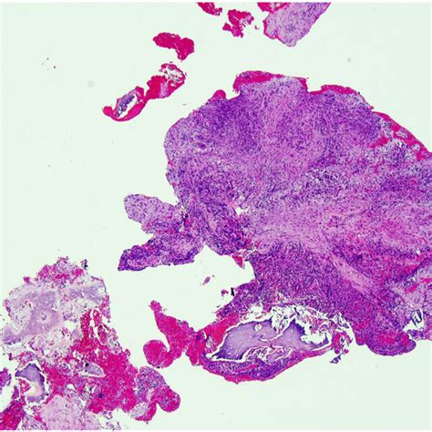 Photomicrograph Showing Fibrous Tissue Having Diffuse Chronic