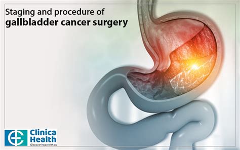 Staging And Procedure Of Gallbladder Cancer Surgery Clinica Health