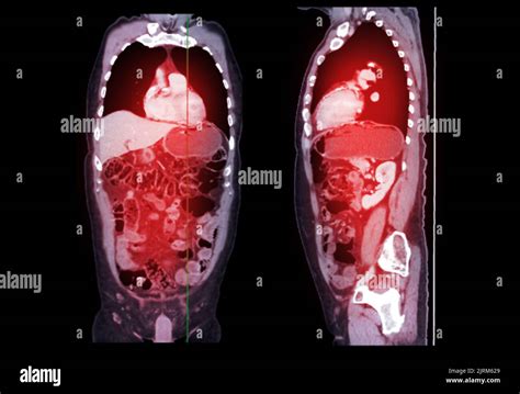 Ct Scan Of Chest And Abdomen Coronal And Sagittal View With Injection