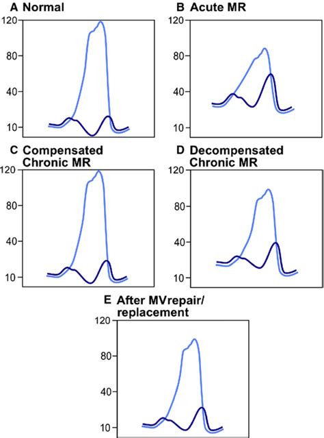Left Ventricular And Left Atrial Hemodynamics Under Various Conditions Download Scientific