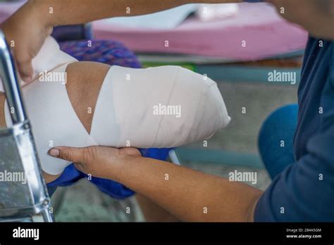 Below Knee Amputation Stump Hi Res Stock Photography And Images Alamy