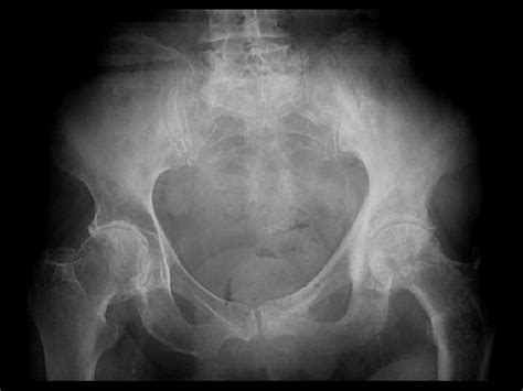 Anterior Shoulder Dislocation Findings Inferomedial Subcoracoid