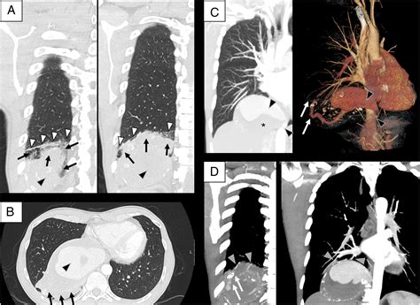 Extralobar Pulmonary Sequestration With An Aneurysmatic Arterial Supply Archivos De