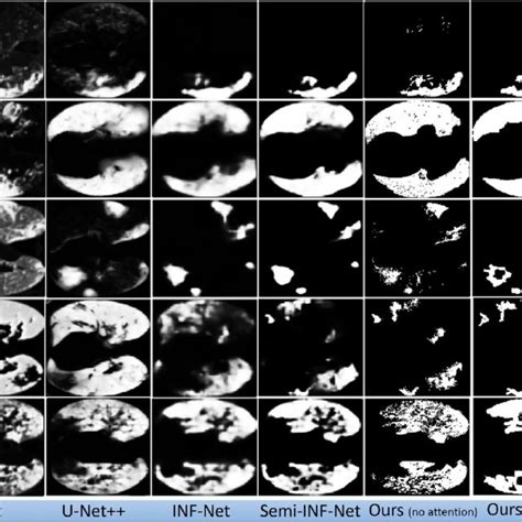 Visual Comparison Of Lung Lesion Segmentation Result Download