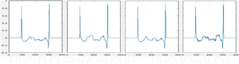 Figure 1 From Electrocardiogram Recognization Based On Variational Autoencoder Semantic Scholar