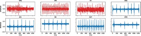 Figure 1 From A Deep Learning Approach For Ventricular Arrhythmias Classification Using