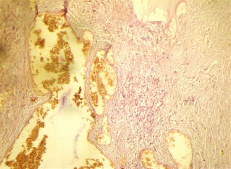 Deep Dermis Showing Mixed Capillary And Cavernous Areas Hande 10x