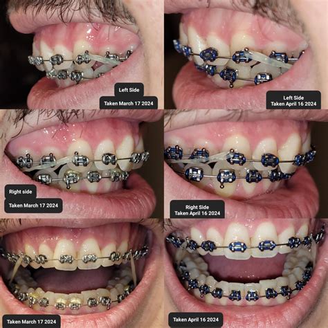Bite Progress R Braces