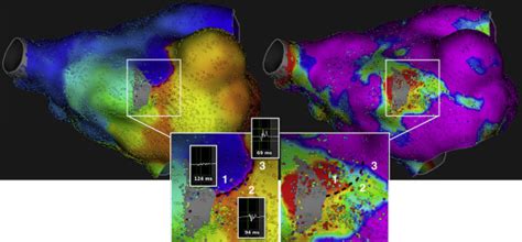 Electrogram Signature Of Specific Activation Patterns Analysis Of Atrial Tachycardias At High