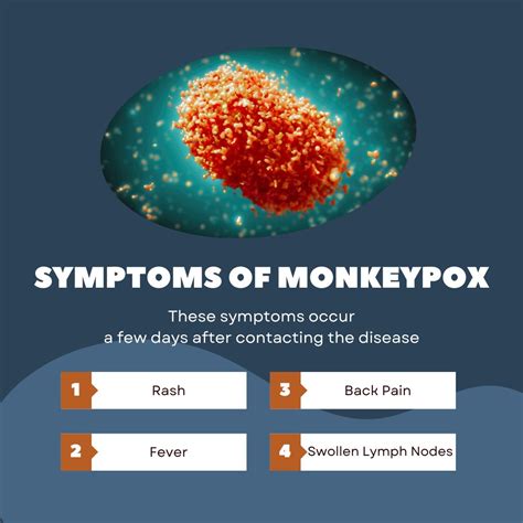 Monkeypox Outbreak Hits The United States The Cougar Press