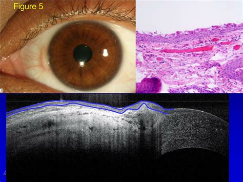 Ppt Ultra High Resolution Optical Coherence Tomography In The