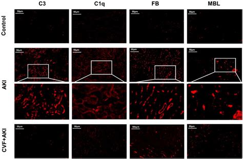 Evaluation Of Renal C3 And Markers For All Three Complement Pathways In