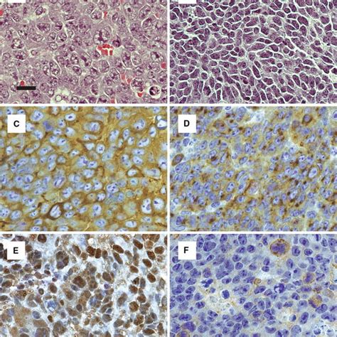 Histopathology Of Myc − Tp53 Medulloblastomas A Large Cell Anaplastic