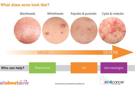 What Type Of Acne Do You Have Types Of Acne Explained Online Ai