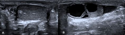 Frontiers Ultrasonography For Disorders Of Sex Development In Pediatrics