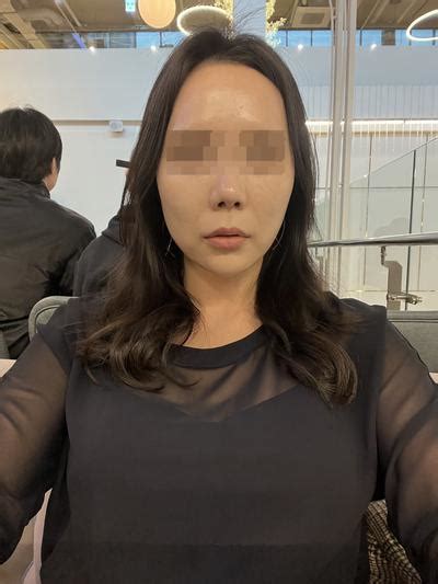 관자놀이 얼굴지방이식시술방법 선택 안함 시술・수술후기 By 니기변경 바비톡