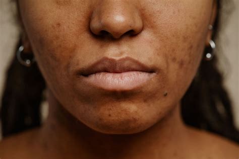 Acne Marks Vs Acne Scars Whats The Difference Curology