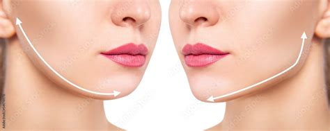 Woman Before And After Cheekbones Shape Correction Stock Photo Adobe Stock