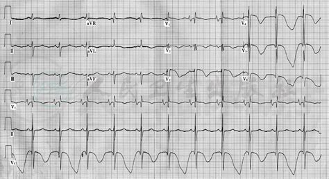 心电图详情 心电图 人卫临床助手 人民卫生出版社