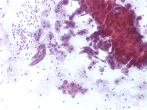 Lsil Eosinophilic And Basophilic Koilocytes Associated With