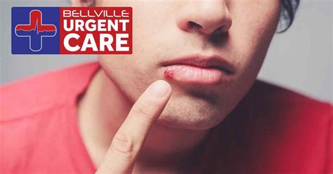 Cold Sores Bellville Urgent Care