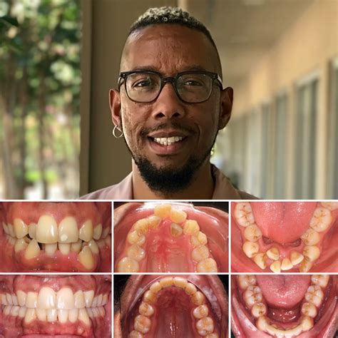 Memphis Braces Invisalign Saddle Creek Orthodontics Dr Fagala
