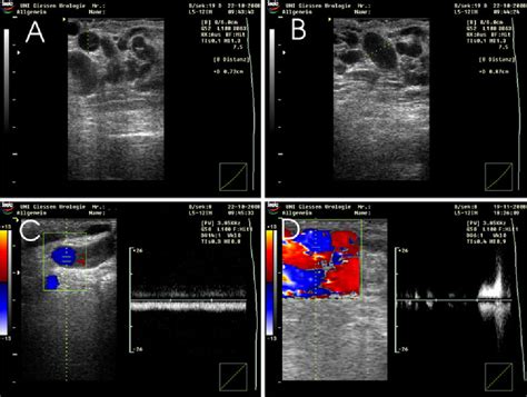 Varicocele Grading