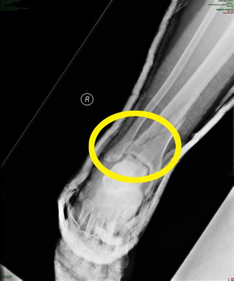 Lower Extremity X Ray Cedars Sinai