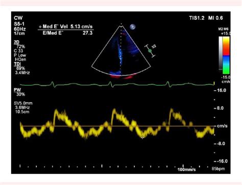 Figure 3 From Severe Diastolic Dysfunction As A Clue To The Cause Of Stroke A Case Report