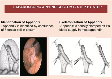 Acute Appendicitis Appendicectomy Open And Laparoscopic Pdf Surgery