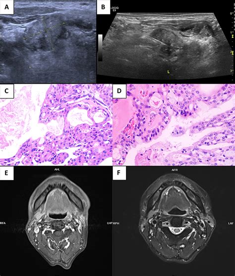 A Case Of Empyema Caused By Mixed Infection With Streptococcus Interme