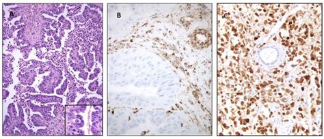 Fumarate Hydratasedeficient Renal Cell Carcinoma
