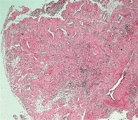 Photomicrograph Of The Lesion Fascicular Pattern Of The Spindle Shaped