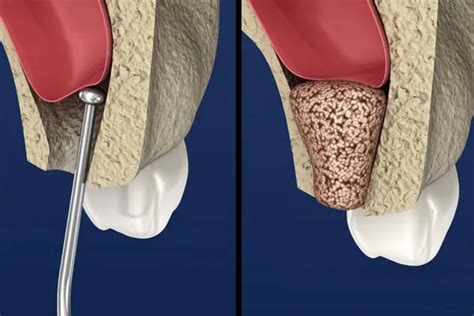 Dental Bone Graft Specialist North York Lee And Yoon Dental