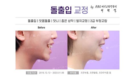 기장민락해운대 교정치과 돌출입교정돌출입잇몸돌출덧니좁은상악발치교정2급부정교합 Banda 해운대교정전문의치과