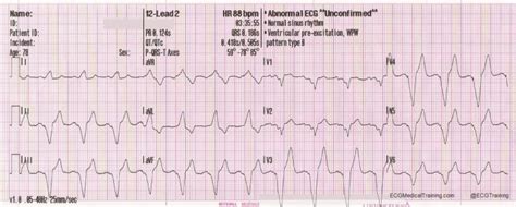 Wolff Parkinson White Syndrome Part 1 Ecg Medical Training