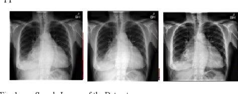 Figure 1 From Cardiomegaly Detection Using Deep Convolutional Neural