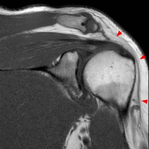 Synovial Cyst Shoulder