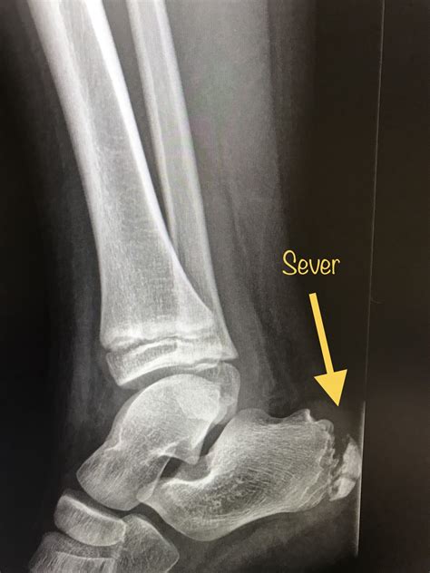 Enfermedad De Osgood Schlatter Sinding Larsen Johansson Y Sever La