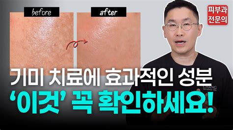 기미 먹는약 도란사민 트라넥삼산 효과와 부작용 피부과 전문의가 알려드립니다 Youtube