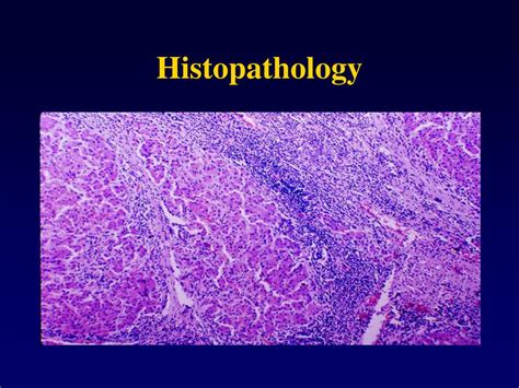 Ppt Liver Cirrhosis Powerpoint Presentation Free Download Id217163