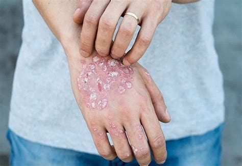 Bệnh Eczema Là Gì Nguyên Nhân Phương Pháp điều Trị