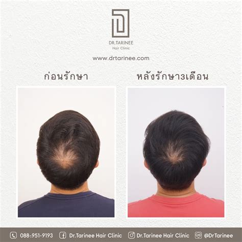 รากผมฝ่อ คืออะไร รากผมไม่แข็งแรงเสี่ยงผมบางหัวล้านจริงไหม