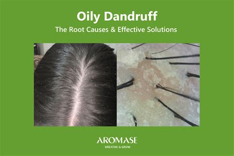 Dandruff Flakes Solution Remedy For Dandruff Remedy Science By Dr