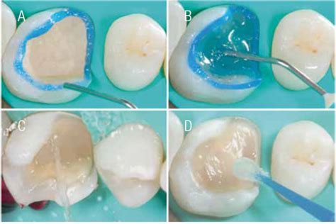 Rehabilitating Form Function And Natural Aesthetics With Onlay Ceramic