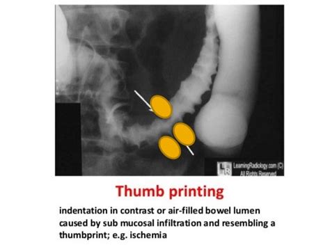 Ischemic Colitis