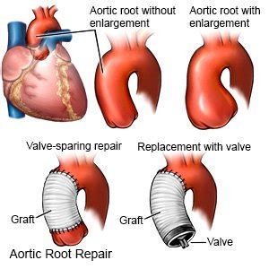 Aortic Root