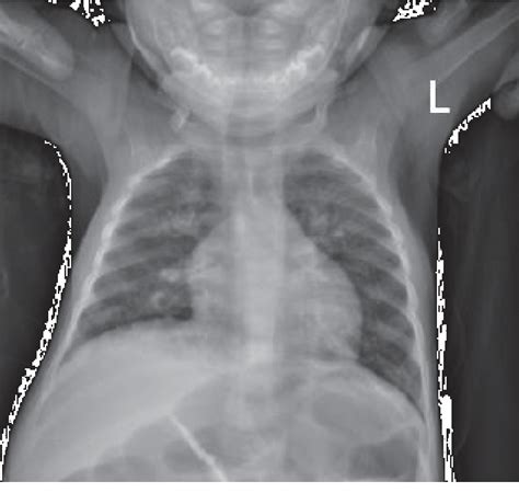 A First Case Report Of Digeorge Syndrome From Ethiopia Highlights
